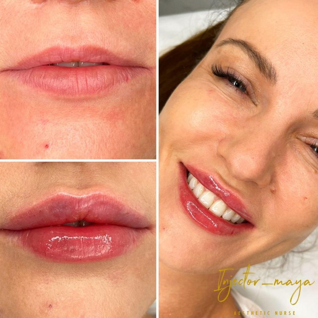 Baby Doll Lips - Injector Maya
