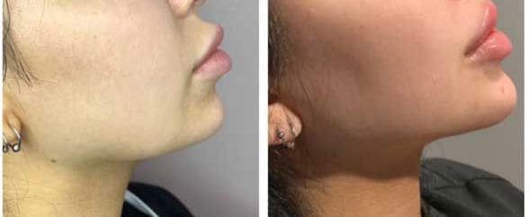 CHIN FILLER - Injector Maya