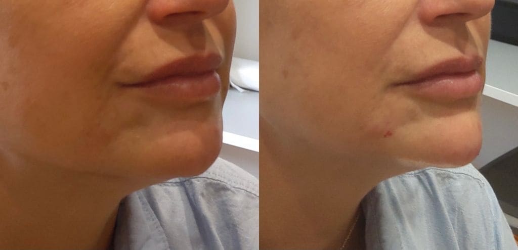 CHIN FILLER - Injector Maya