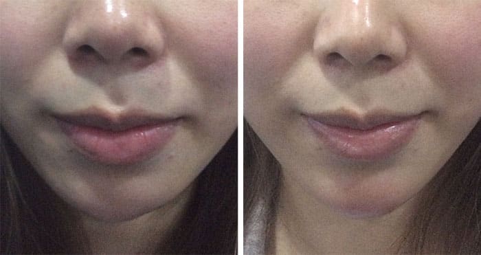 CHIN FILLER - Injector Maya
