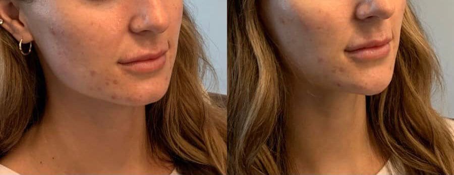 CHIN FILLER - Injector Maya