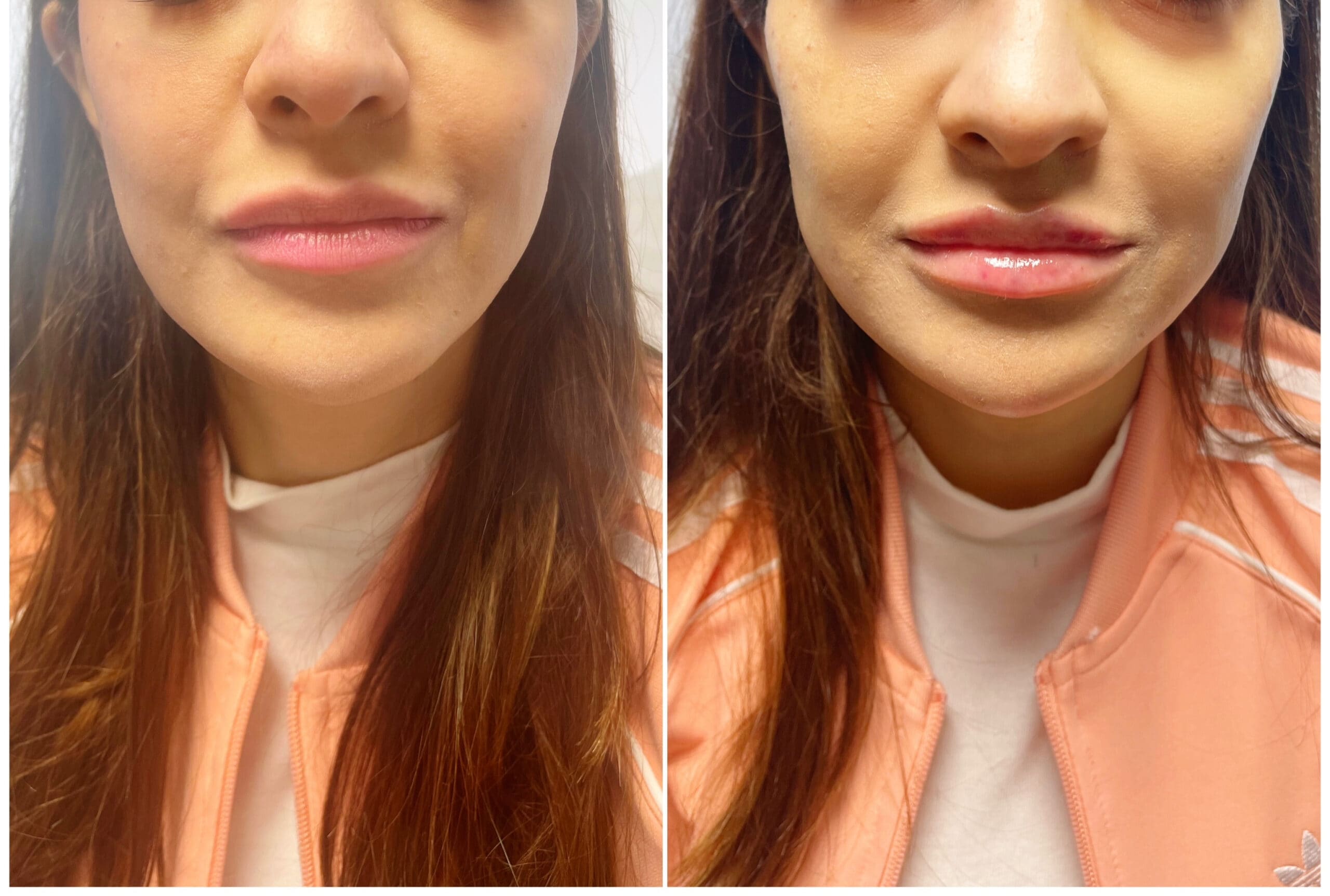 CHIN FILLER - Injector Maya