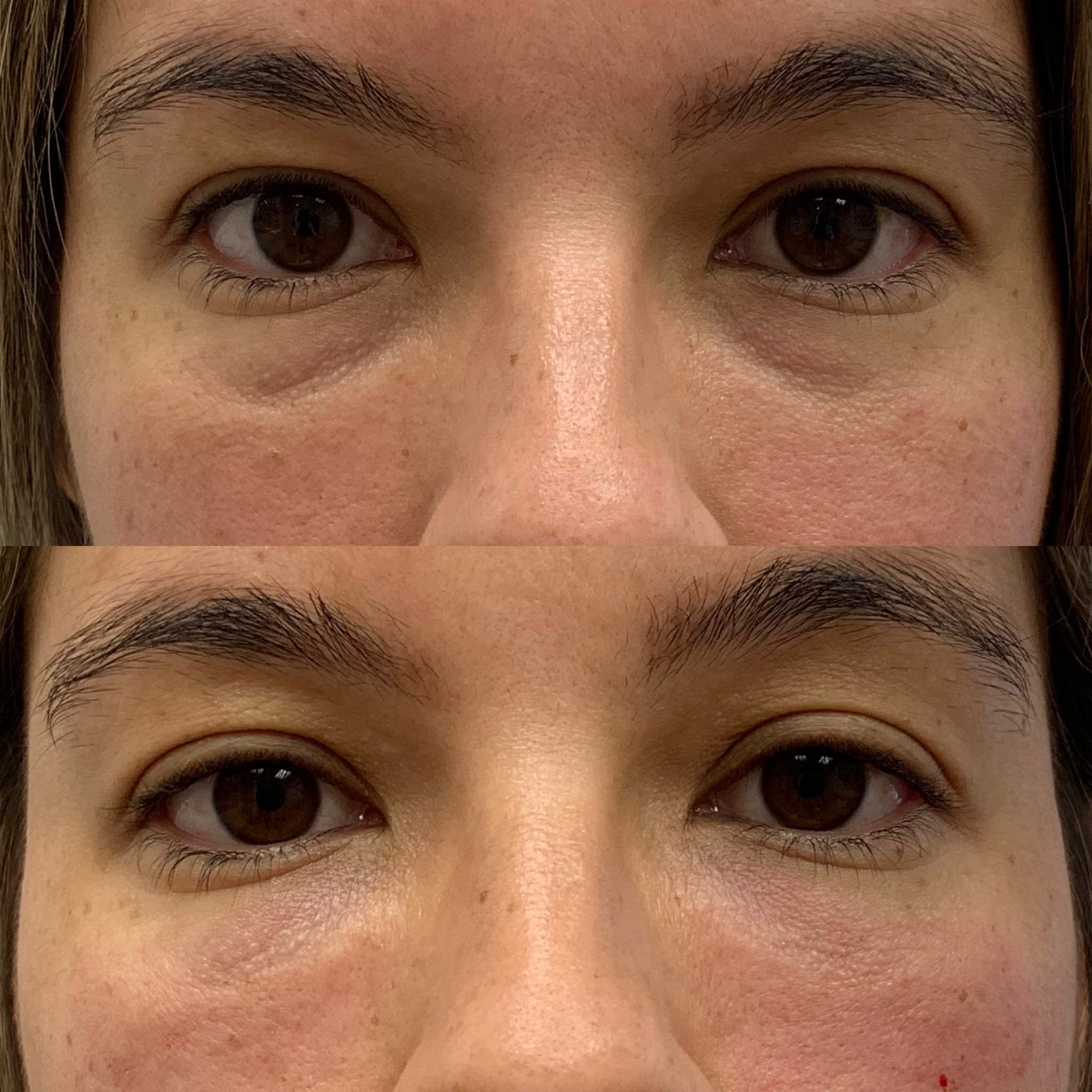 Dark Circles - Injector Maya