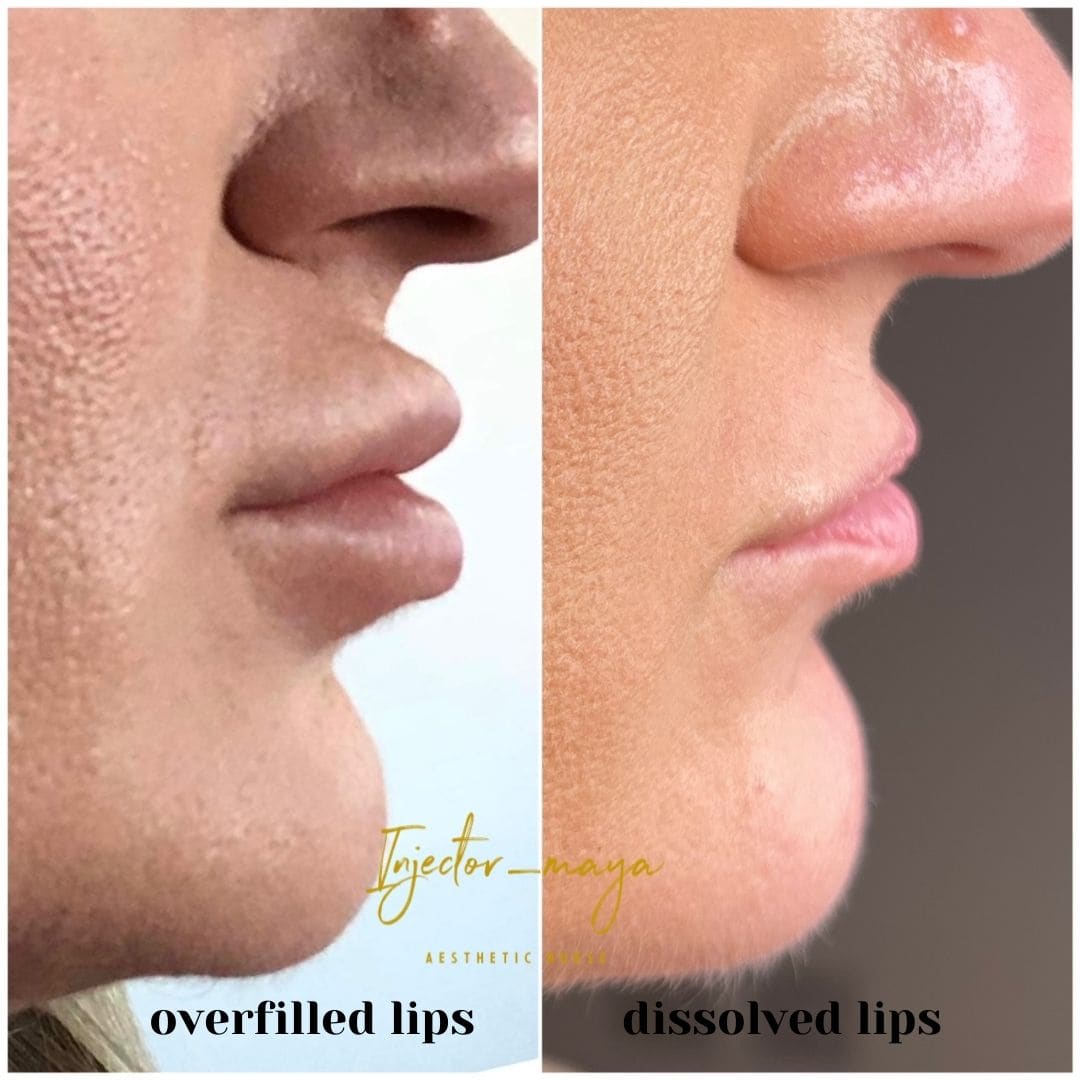 Dissolving Old Fillers - Injector Maya