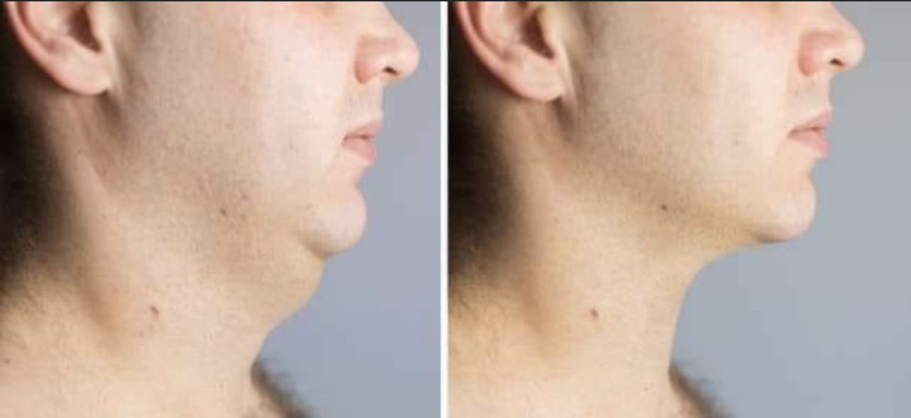 Double Chin Reduction - Injector Maya