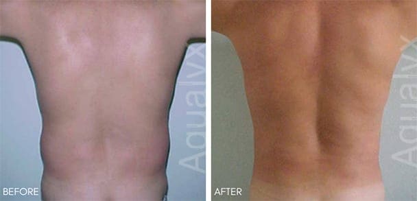 Fat-dissolving injections - Injector Maya