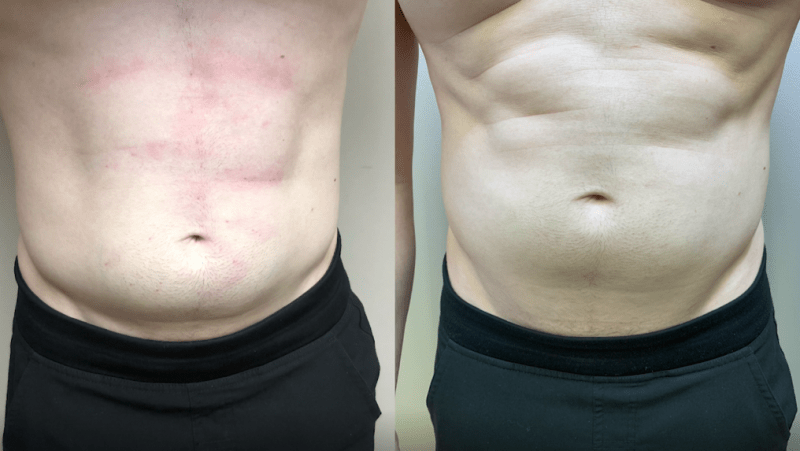 Fat-dissolving injections - Injector Maya