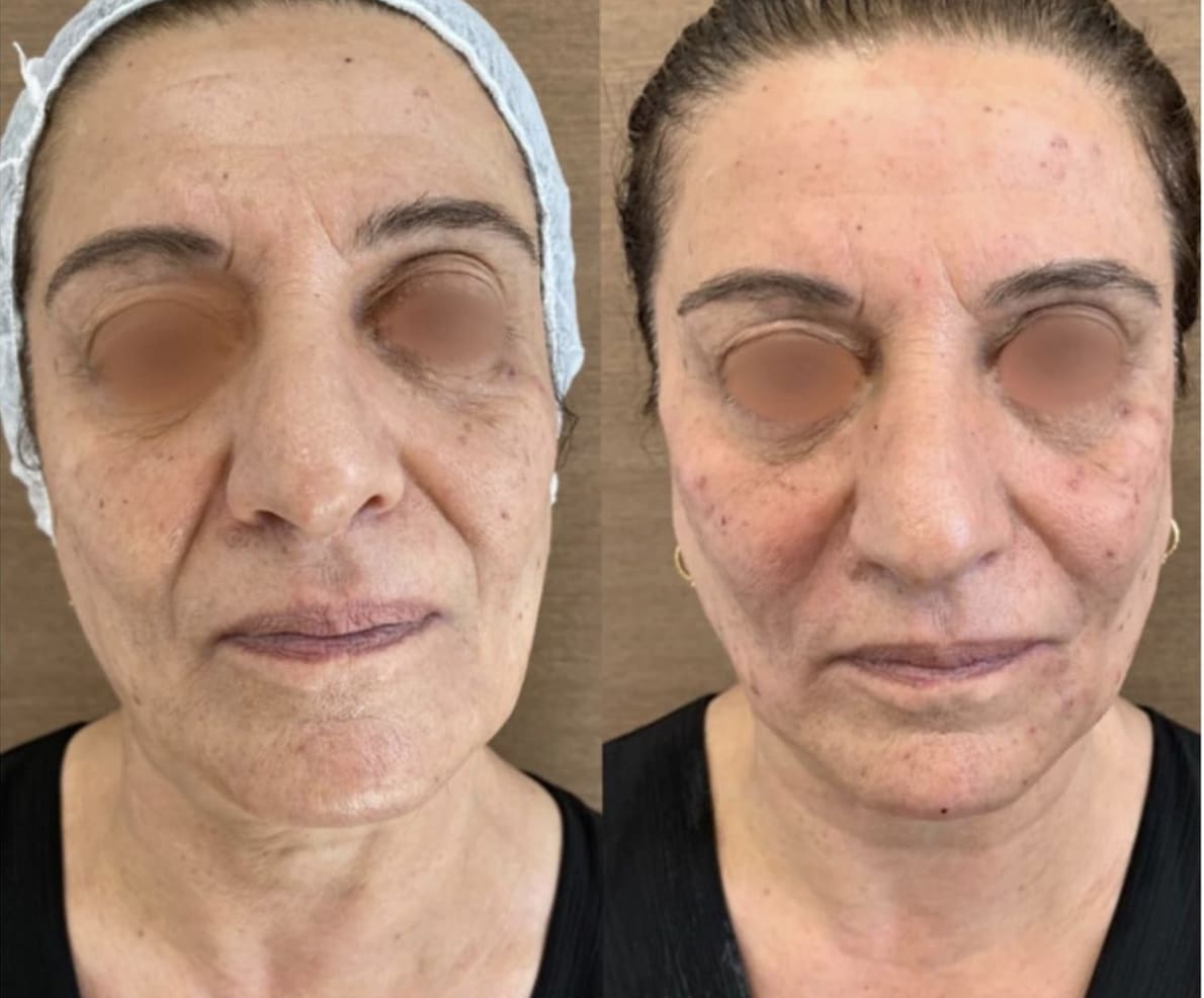 Jalurpo Super Hydro - Injector Maya