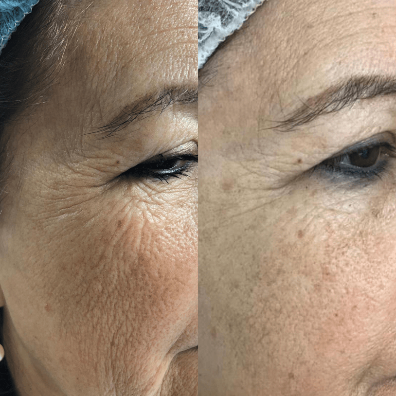 Mesotherapy - Injector Maya