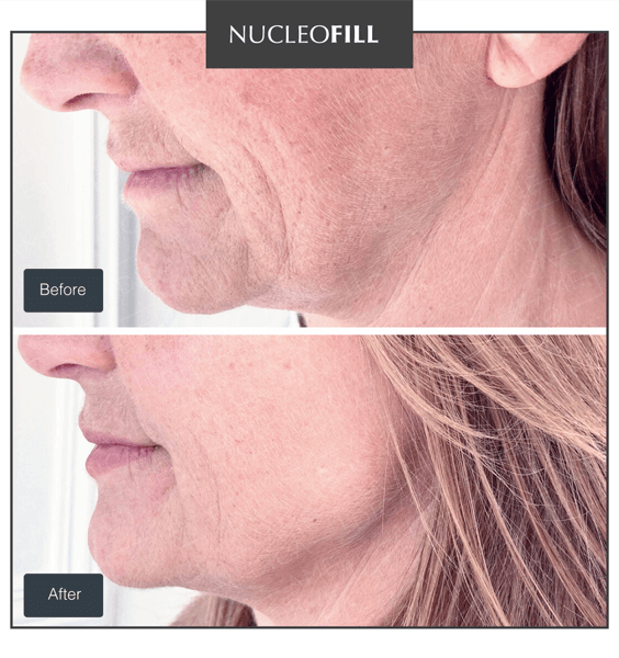 Nucleofill - Injector Maya