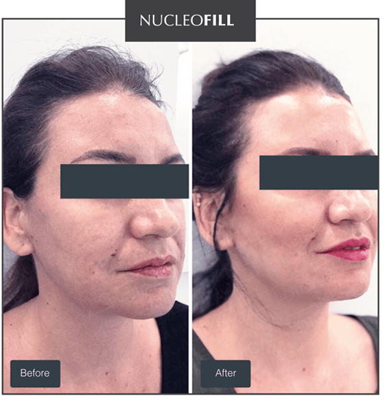 Nucleofill - Injector Maya