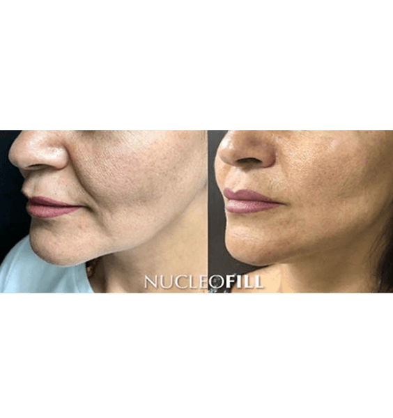 Nucleofill - Injector Maya