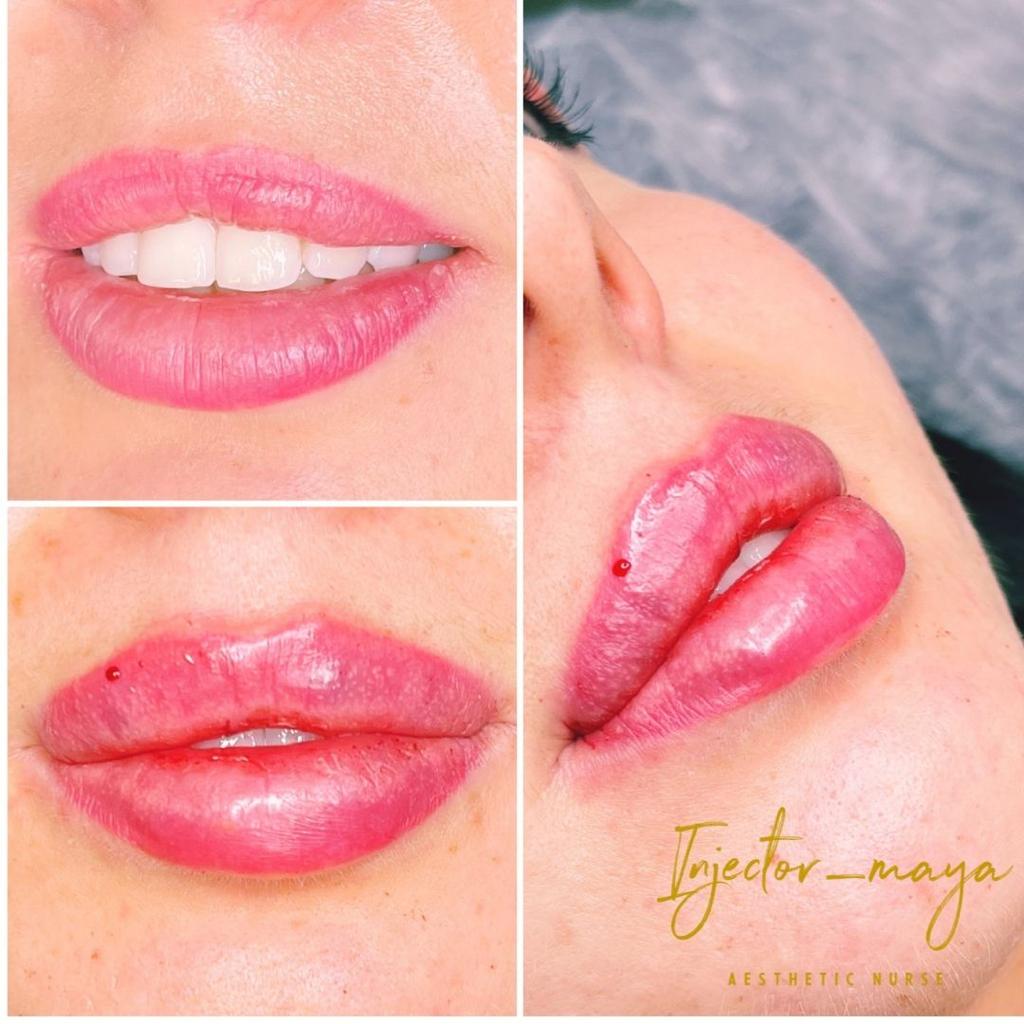 Russian Lips - Injector Maya