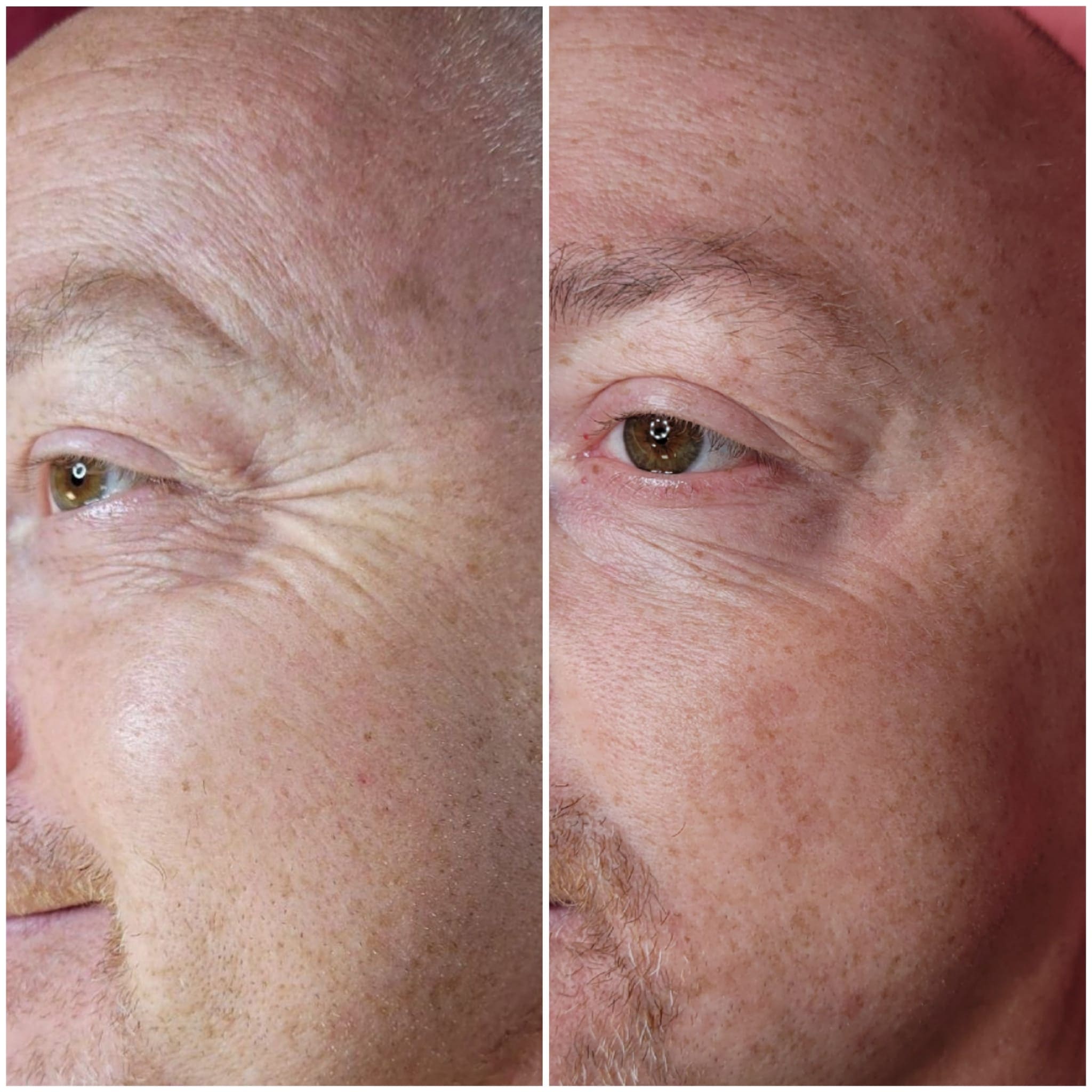 Sunekos - Injector Maya